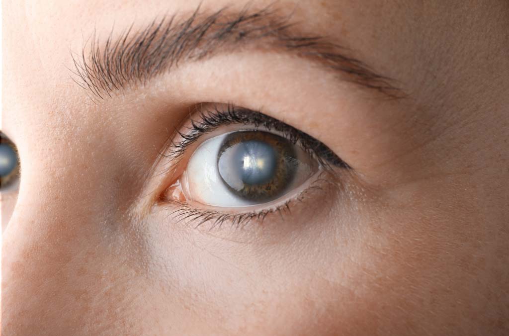 Cataracts and Your Vision: Causes, Symptoms, and How to Manage Them ...